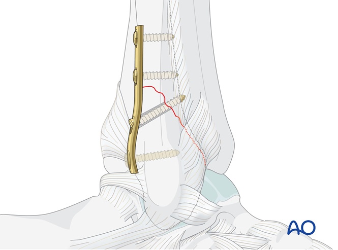 Antiglide plate for Transsyndesmotic, lateral isolated simple fracture