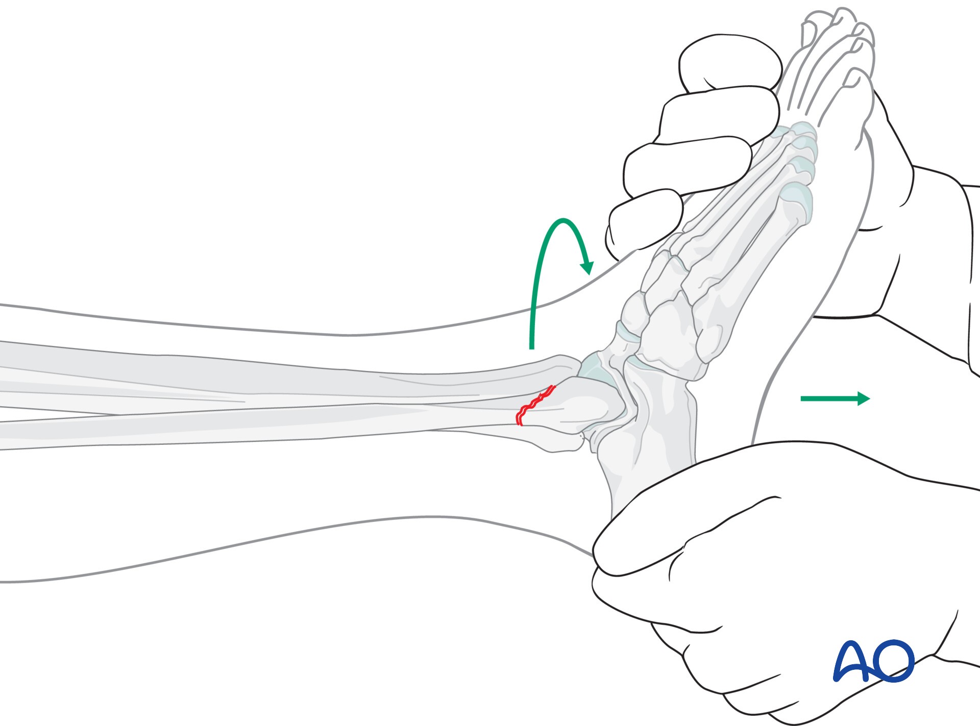 Antiglide plate for Transsyndesmotic lateral isolated simple fracture