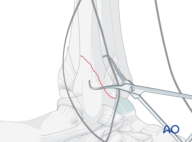 Fibula, oblique fracture: antiglide plate