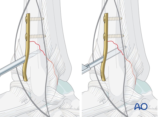 Antiglide plate for Transsyndesmotic, lateral isolated simple fracture