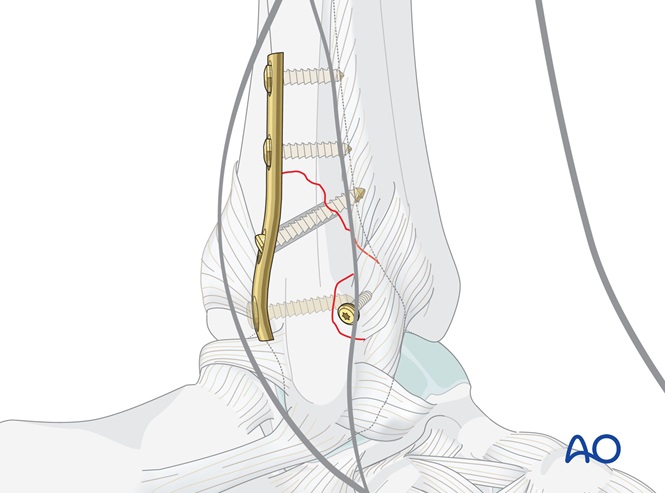 Fibula, oblique fracture: antiglide plate