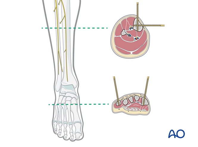 Triangular external fixation for Transsyndesmotic, posterior, lateral ...