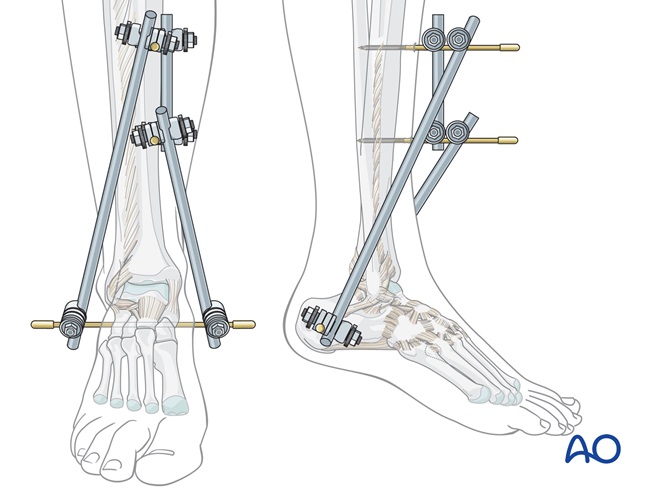 Triangular external fixation for Transsyndesmotic, lateral simple ...