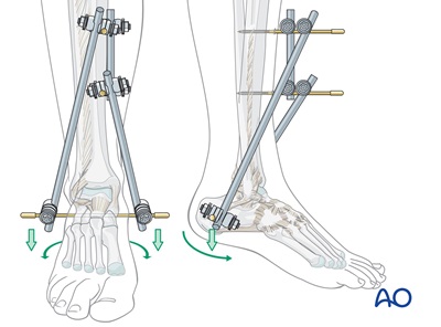 Triangular external fixation for Transsyndesmotic, lateral simple ...
