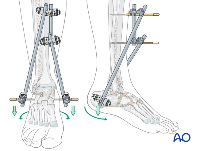 Triangular external fixation for Transsyndesmotic, lateral simple ...