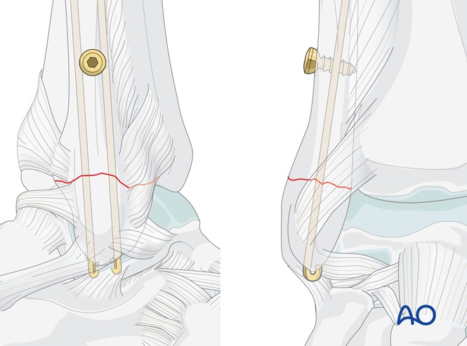 Fibula, transverse fracture: cerclage compression wire