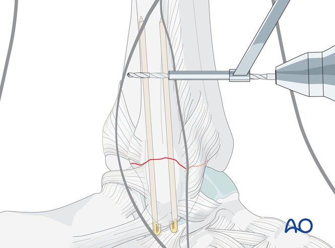 Tension band wiring for Infrasyndesmotic, lateral isolated fracture