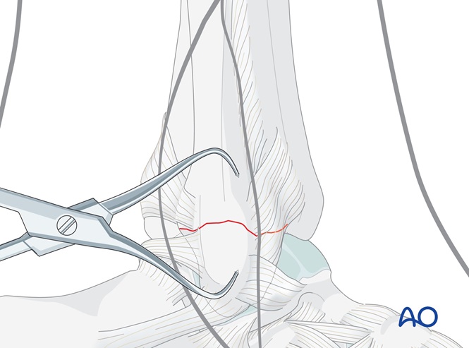 Fibula, transverse fracture: tension band wiring