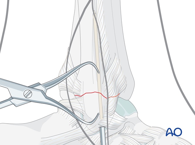 Fibula, transverse fracture: tension band wiring