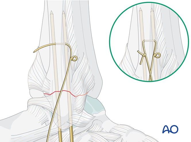 Fibula, transverse fracture: tension band wiring