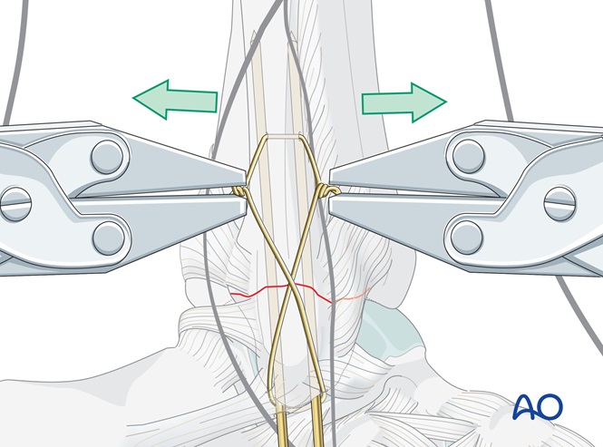 Fibula, transverse fracture: tension band wiring