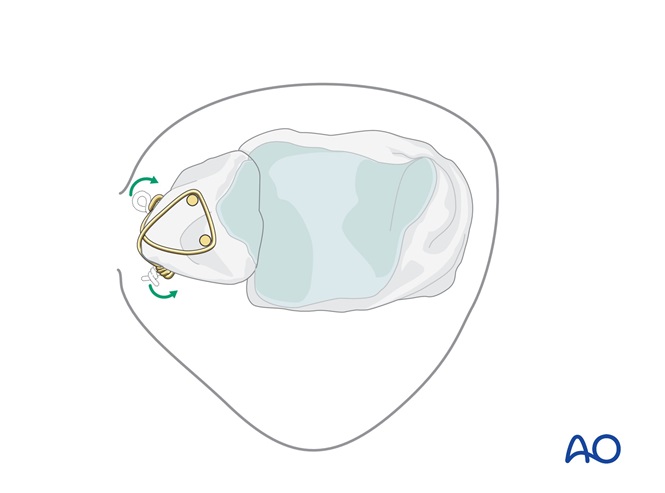 Fibula, transverse fracture: cerclage compression wire