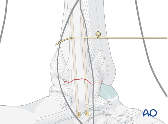 Fibula, transverse fracture: tension band wiring