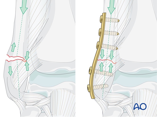 Fibula, transverse fracture: tension band plate