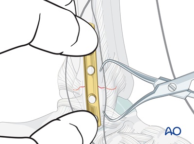 Tension band plate for Infrasyndesmotic, lateral isolated fracture