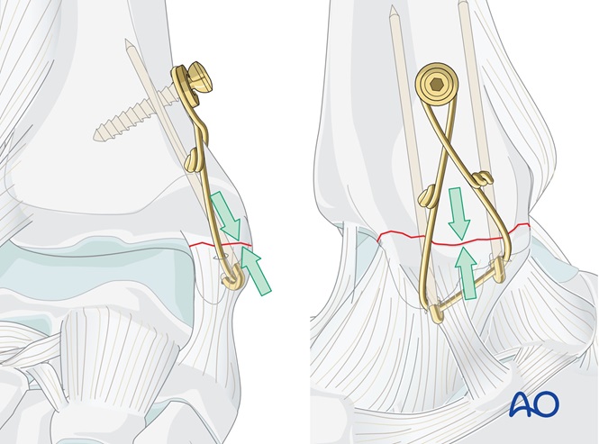 Medial, transverse fracture: tension band wiring
