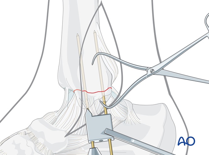 Medial, transverse fracture: tension band wiring