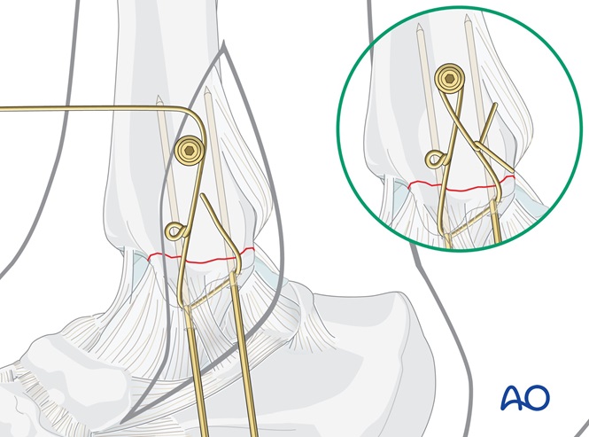 Medial, transverse fracture: tension band wiring