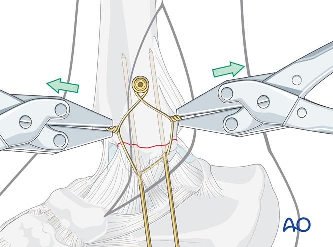 Medial, transverse fracture: tension band wiring