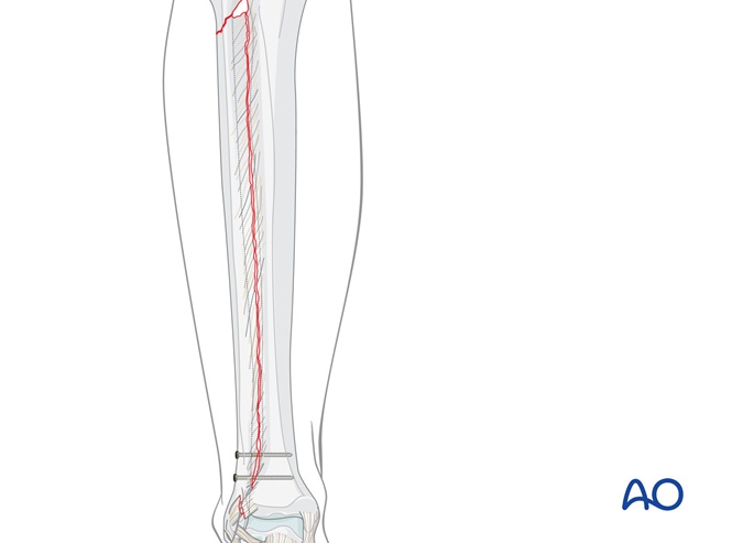 Syndesmosis injury: Fibulo-tibial positioning screw