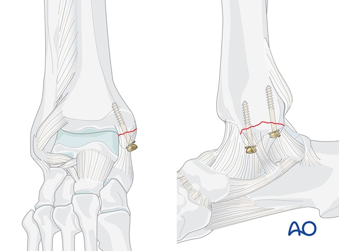 ORIF for Suprasyndesmotic, simple fibular fracture, medial injury ...
