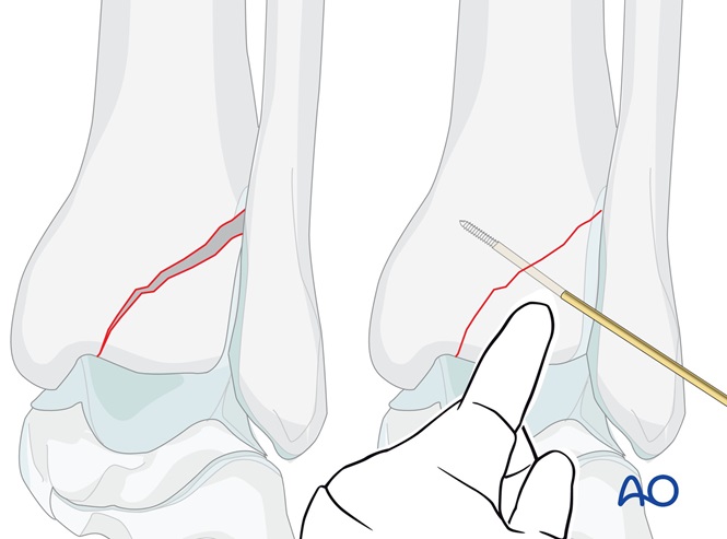 Volkmann fracture: posterior lag screw
