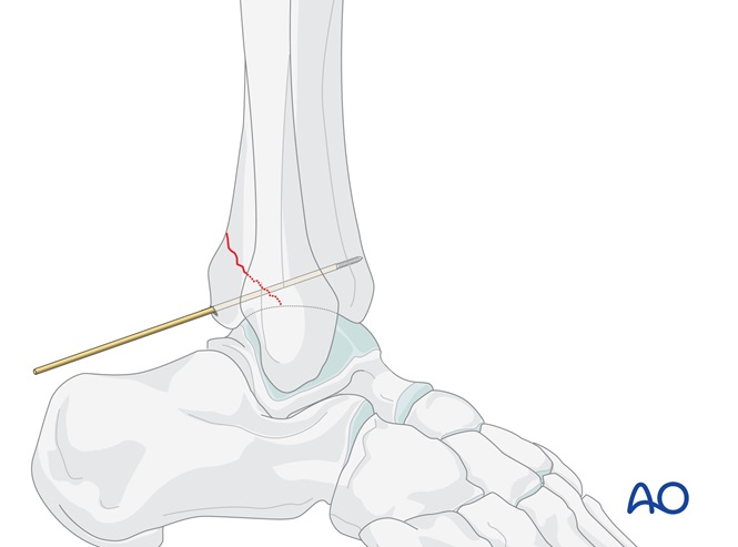 Volkmann fracture: posterior lag screw