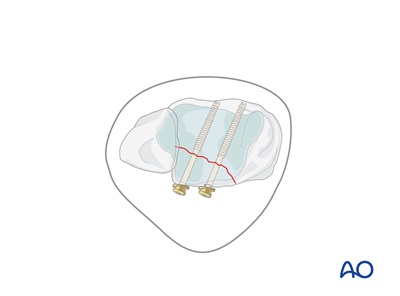 ORIF for Suprasyndesmotic, simple fibular fracture, medial injury ...