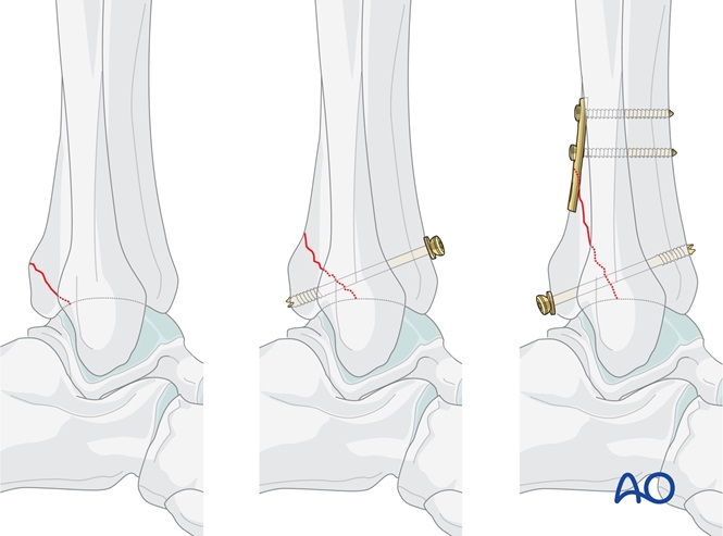 Volkmann fracture: anterior lag screw
