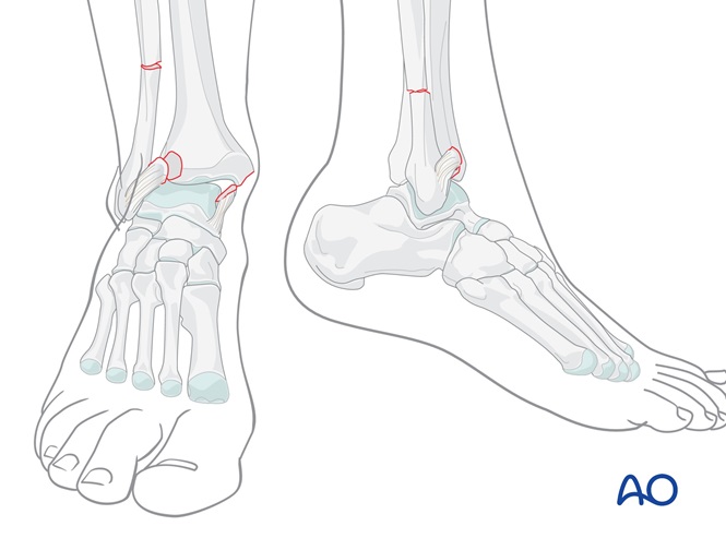 Long-leg circular cast for Suprasyndesmotic, simple fibular fracture ...