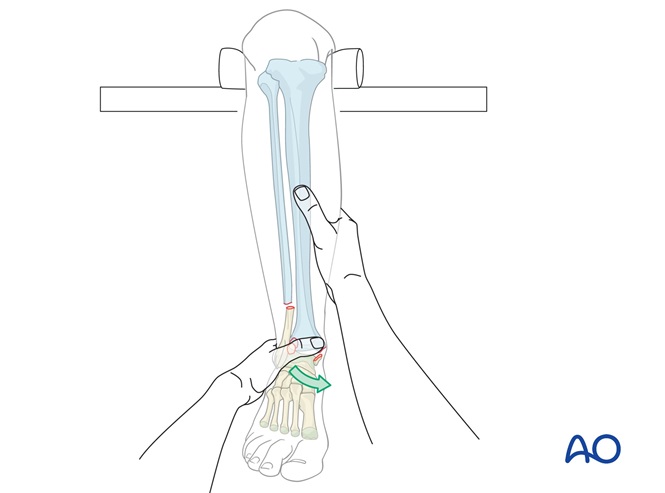 Long-leg circular cast for Suprasyndesmotic, simple fibular fracture ...