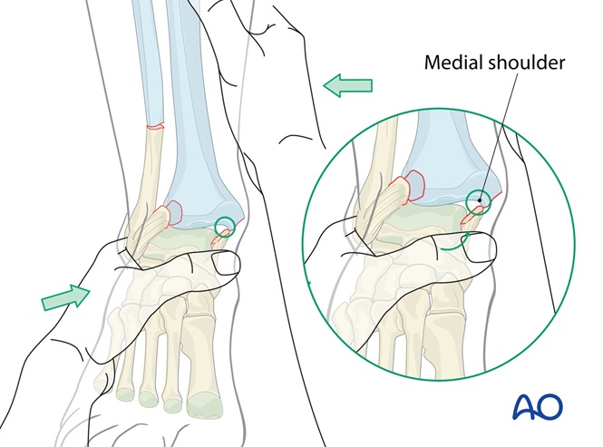 Malleoli fracture management with minimal resources