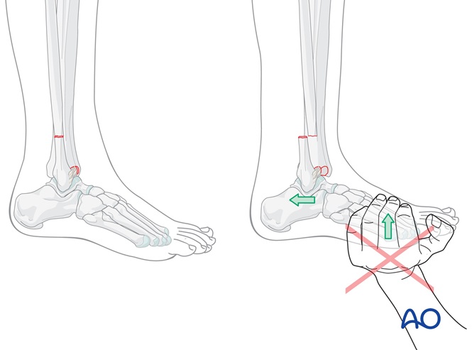 Long-leg circular cast for Suprasyndesmotic, simple fibular fracture ...