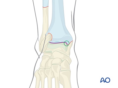 Long-leg circular cast for Suprasyndesmotic, simple fibular fracture ...