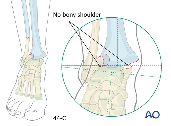 Malleoli fracture management with minimal resources