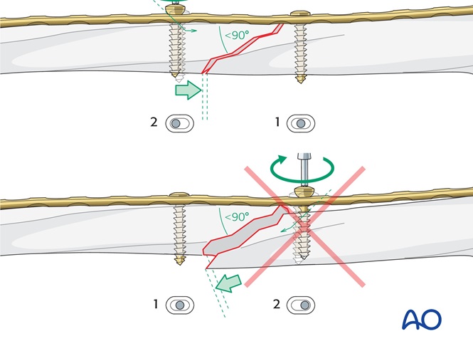 Fibula, transverse or oblique fracture: compression plate