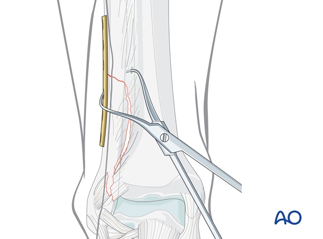 Fibula, transverse or oblique fracture: compression plate