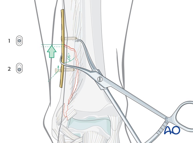 Fibula, transverse or oblique fracture: compression plate