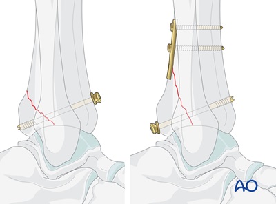Volkmann fracture: anterior lag screw