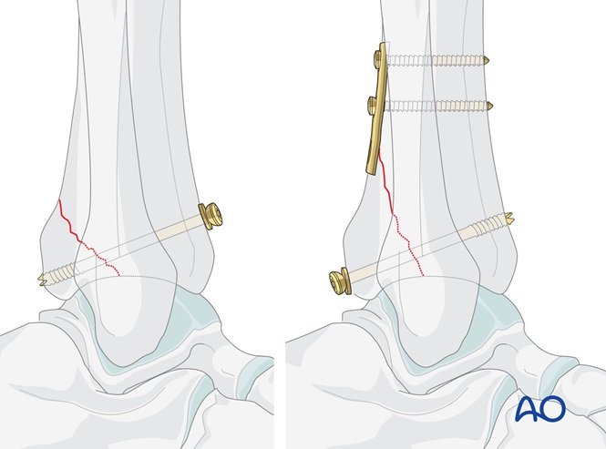Volkmann fracture: anterior lag screw