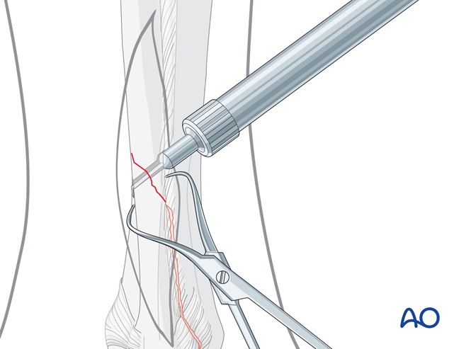 Fibula, oblique C1 fracture: lag screw and neutralization plate
