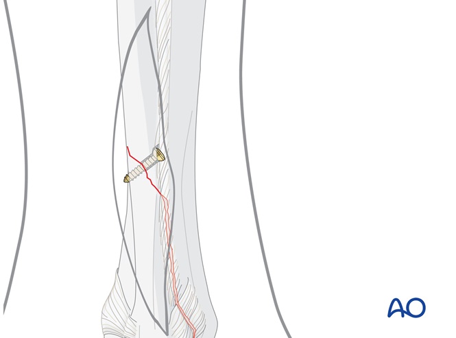 Fibula, oblique C1 fracture: lag screw and neutralization plate
