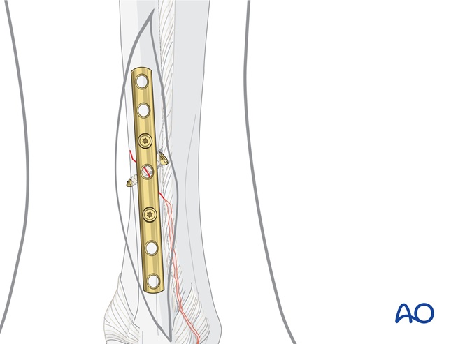 Fibula, oblique C1 fracture: lag screw and neutralization plate