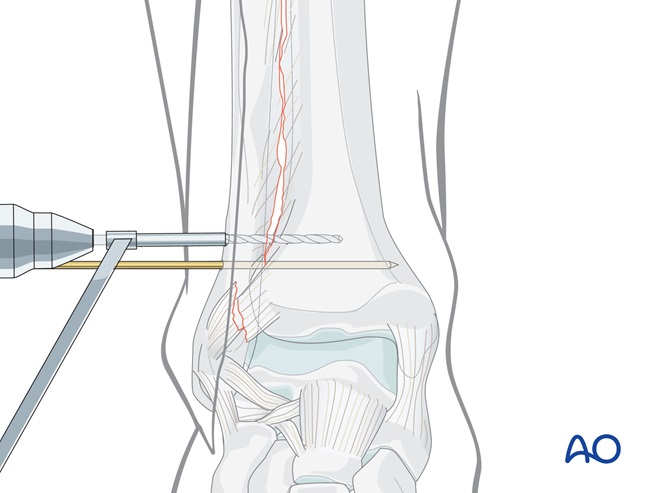 Syndesmosis injury: Fibulo-tibial positioning screw