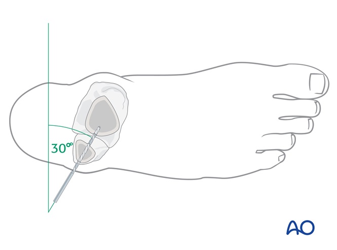 Syndesmosis injury: Fibulo-tibial positioning screw