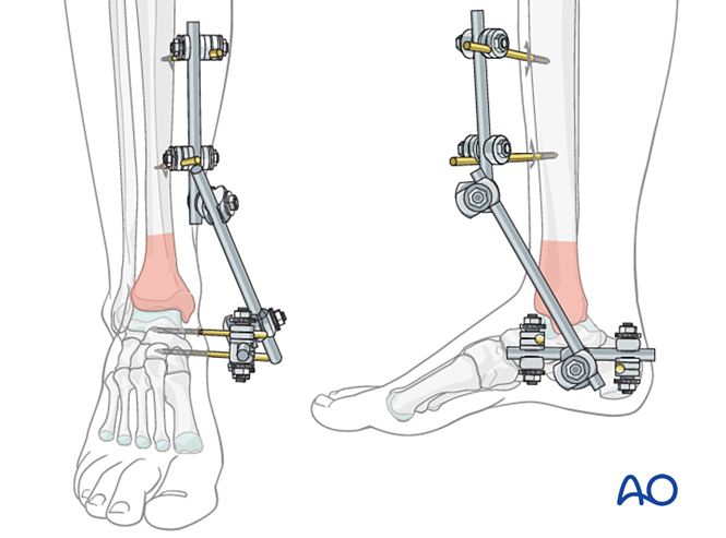External fixation for Suprasyndesmotic, proximal fibular fracture ...