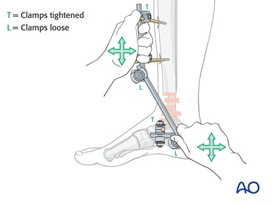 External fixation for Infrasyndesmotic, medial fracture with lateral ...