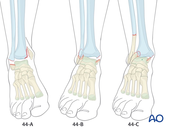 Malleoli fracture management with minimal resources