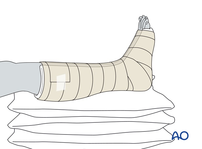 Malleoli fracture management with minimal resources