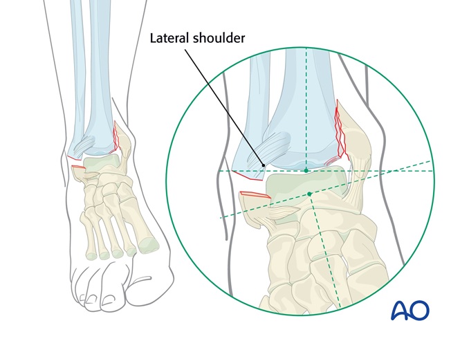Malleoli fracture management with minimal resources